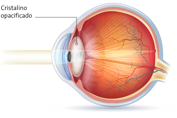 Catarata - Medicina Ocular